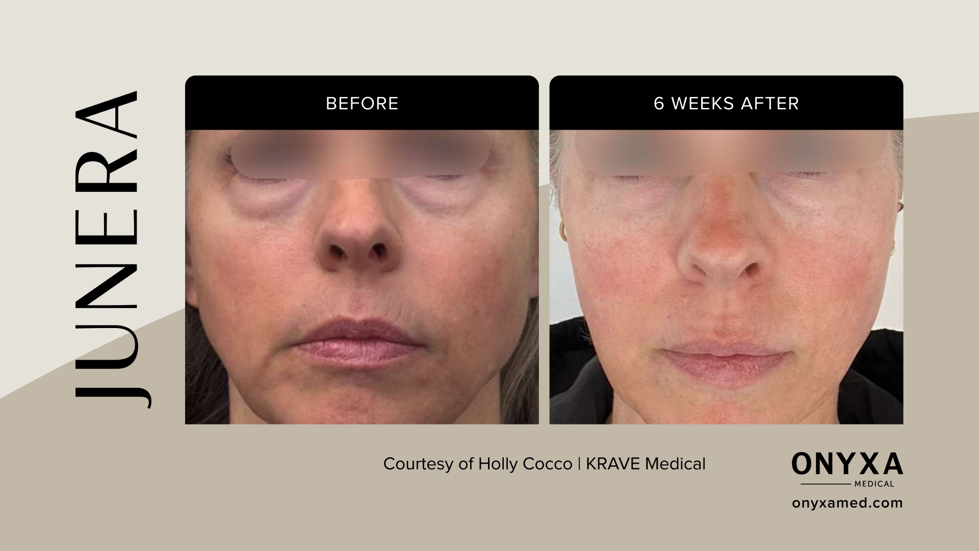 Onyxa Medical — Junera Subdermal Laser | Laxity, Fat, or Both
